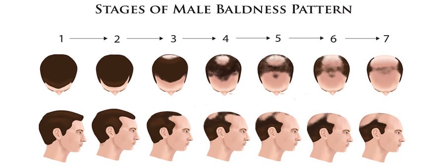 Why Isn’t Minoxidil Working for Me? 3 Reasons Why Why Isn’t Minoxidil Working for Me? 3 Reasons Why